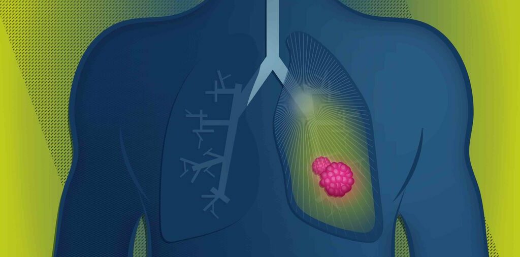 AstraZeneca shares slide on disappointing lung cancer drug trial ... AstraZeneca shares slide on disappointing lung cancer drug trial ...
