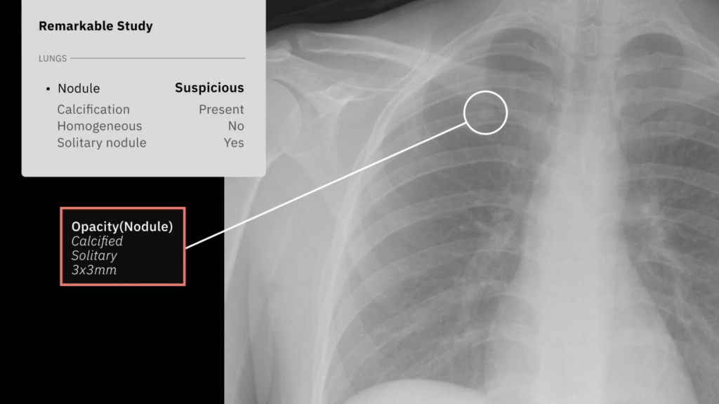 Qure.ai's qXR software helps provide Scottish woman with lung cancer ...