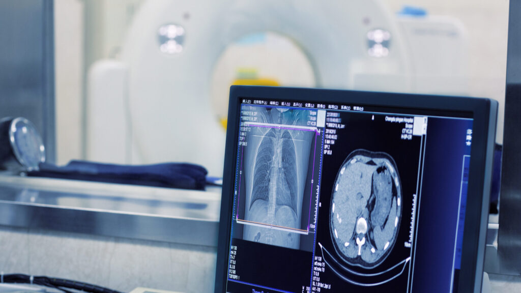 FDA clears Median Technologies lung-nodule risk assessment software ...